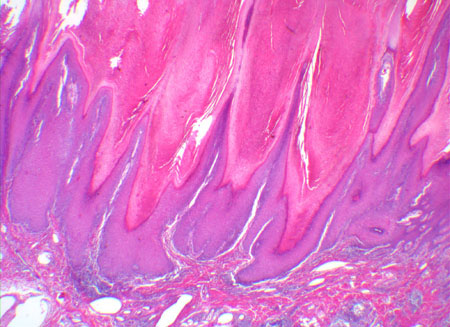 Week 168: Case 6 | Johns Hopkins Surgical Pathology Unknown Conference