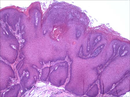 Week 504: Case 2 | Johns Hopkins Surgical Pathology Unknown Conference