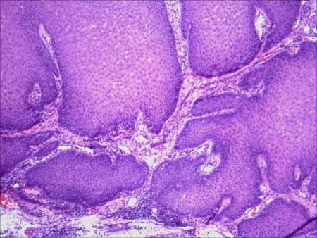 Week 504: Case 2 | Johns Hopkins Surgical Pathology Unknown Conference