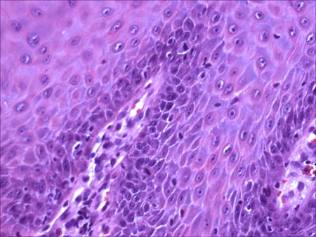 Week 504: Case 2 | Johns Hopkins Surgical Pathology Unknown Conference