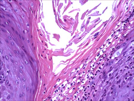 Week 504: Case 2 | Johns Hopkins Surgical Pathology Unknown Conference