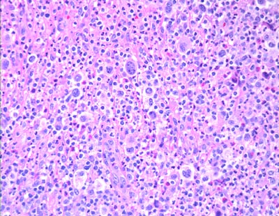 Week 45: Case 5 | Johns Hopkins Surgical Pathology Unknown Conference