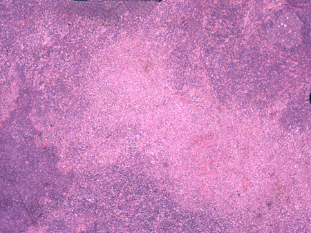 Week 264: Case 2 | Johns Hopkins Surgical Pathology Unknown Conference