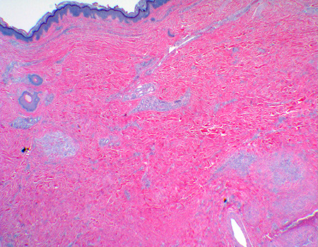 Week 126: Case 3 | Johns Hopkins Surgical Pathology Unknown Conference