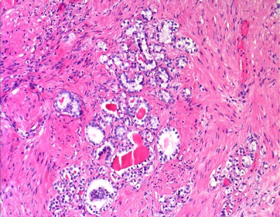 Week 85: Case 1 | Johns Hopkins Surgical Pathology Unknown Conference