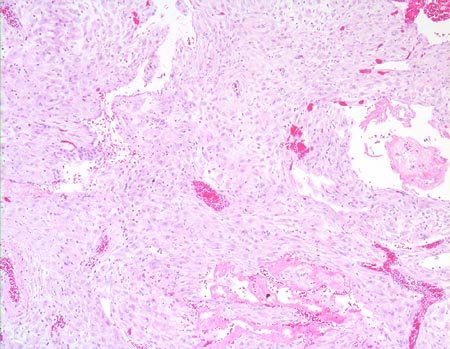 Week 119: Case 6 | Johns Hopkins Surgical Pathology Unknown Conference