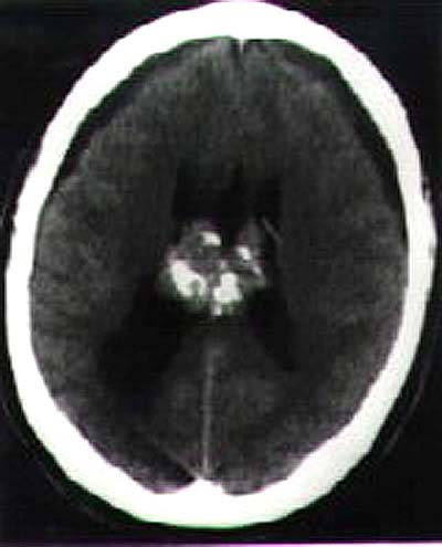 Week 97: Case 1 | Johns Hopkins Surgical Pathology Unknown Conference