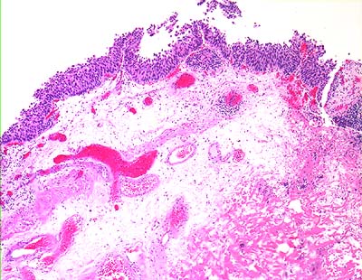 Week 71: Case 2 | Johns Hopkins Surgical Pathology Unknown Conference