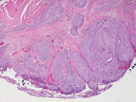 Week 599: Case 2 | Johns Hopkins Surgical Pathology Unknown Conference