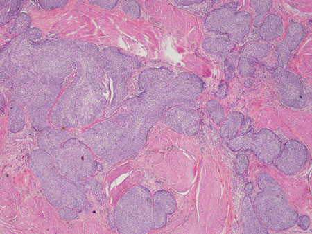Week 599: Case 2 | Johns Hopkins Surgical Pathology Unknown Conference