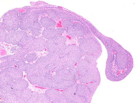 Week 597: Case 2 | Johns Hopkins Surgical Pathology Unknown Conference