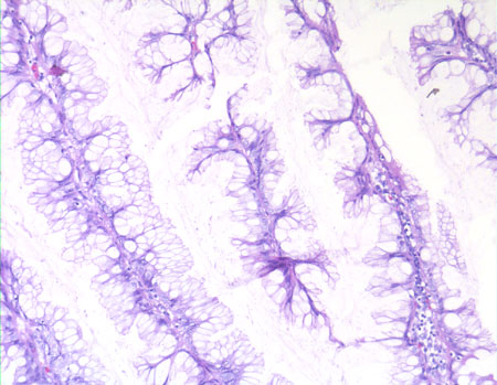 Week 151: Case 2 | Johns Hopkins Surgical Pathology Unknown Conference