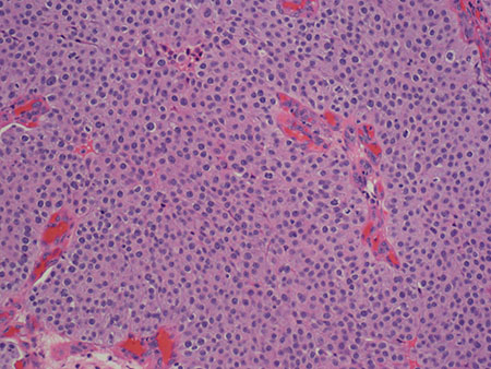 Week 557: Case 3 | Johns Hopkins Surgical Pathology Unknown Conference