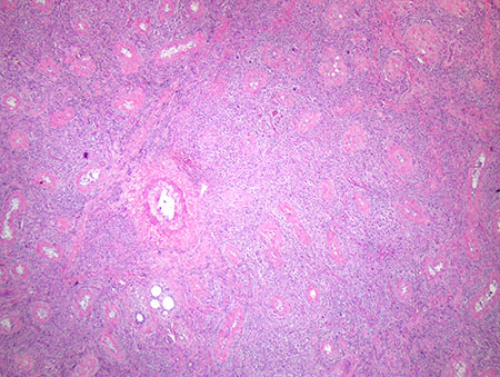 Week 577: Case 1 | Johns Hopkins Surgical Pathology Unknown Conference