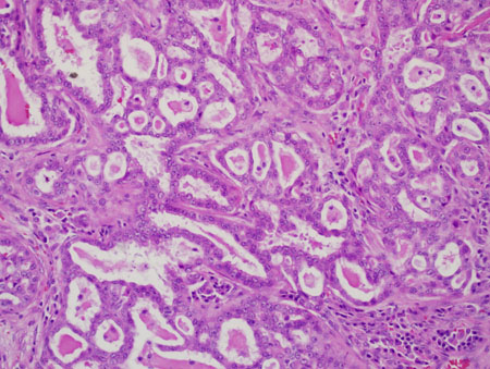 Week 522: Case 1 | Johns Hopkins Surgical Pathology Unknown Conference